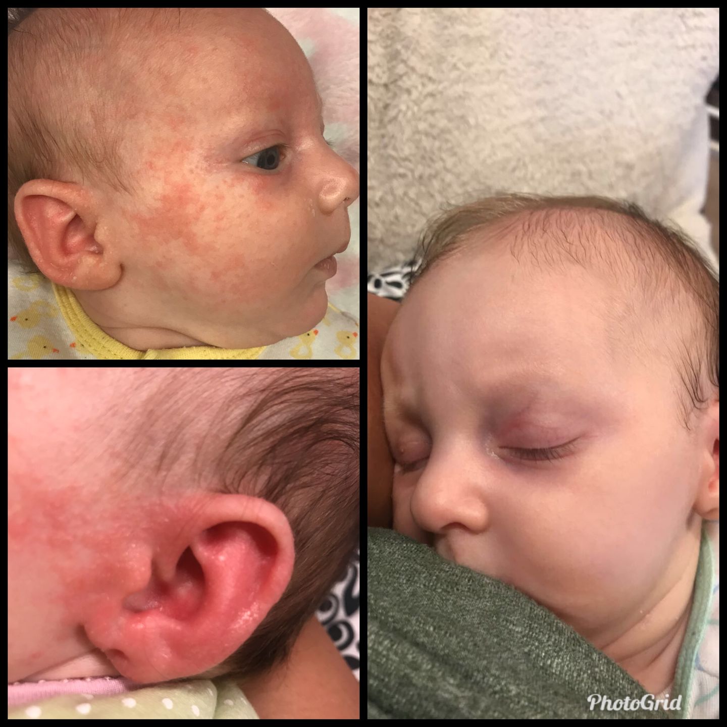 My 8 Week Old Started Out With Baby Acne And It Turned Into Heat Rash My 8 Week Old Started Out With Baby Acne And It Turned Into Heat Rash